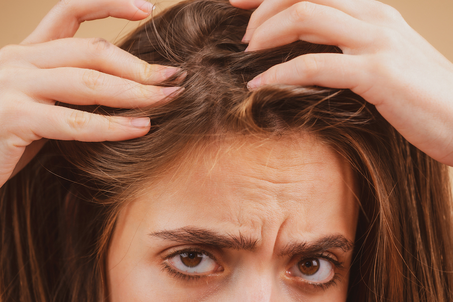 Znate li šta je alopecija?